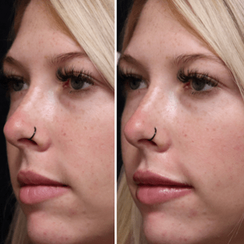 Fillers | Key-Whitman Eye Center