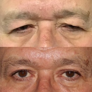 Bilateral Upper Blepharoplasty and Ptosis Repair - Front | Key-Whitman ...