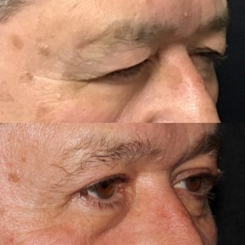 Bilateral Upper Blepharoplasty and Ptosis Repair - Side | Key-Whitman ...
