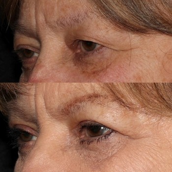 Bilateral Upper Blepharoplasty and Ptosis Repair - Side | Key-Whitman ...