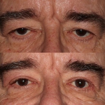 Upper and Lower Blepharoplasty, Ptosis Repair and CO2 Laser Resurfacing ...