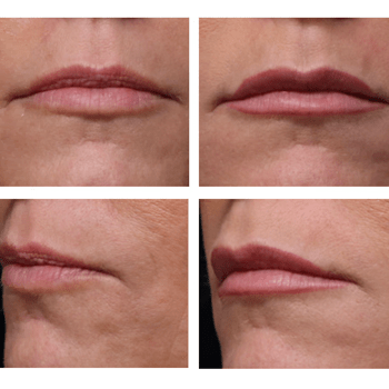 Ptosis Repair - Key-Whitman Eye Center