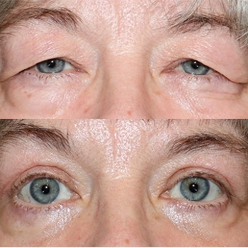 Bilateral Upper and Lower Eyelid Blepharoplasty and Peri-Orbital CO2 ...