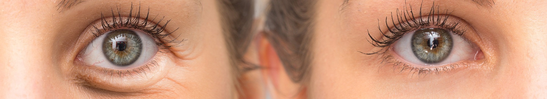 Eyelid Surgery and Treatment | Key-Whitman Eye Center